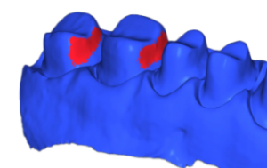 Mesh Healing - MeshLib - 3D Mesh Processing Library Python, C++